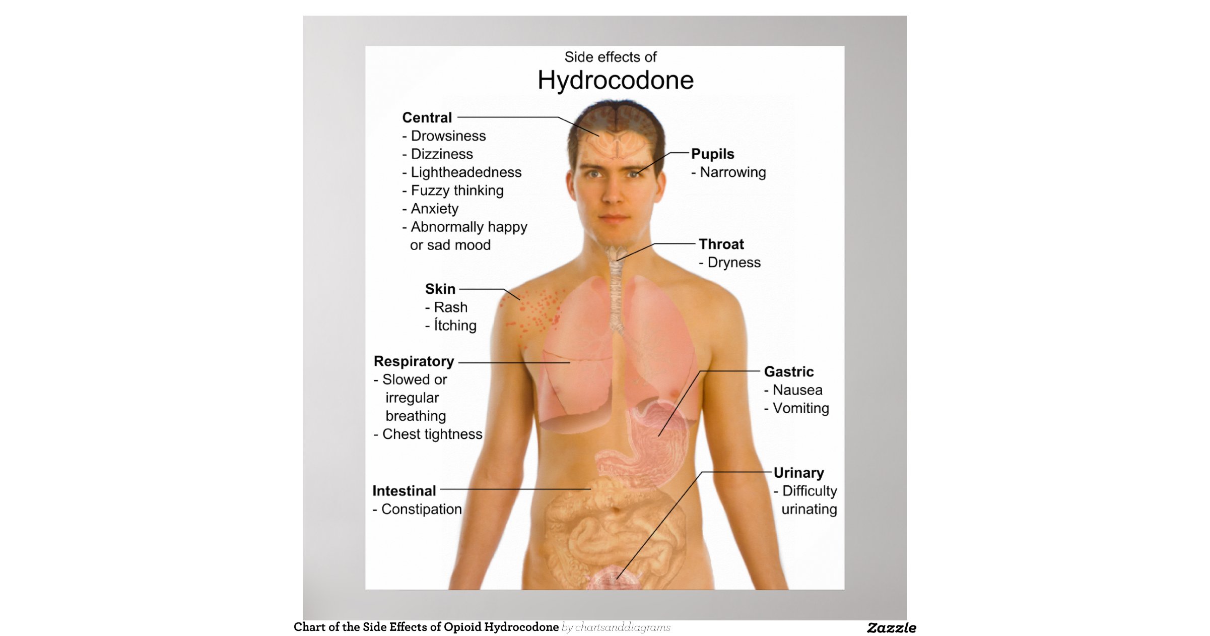 Chart Of The Side Effects Of Opioid Hydrocodone Poster