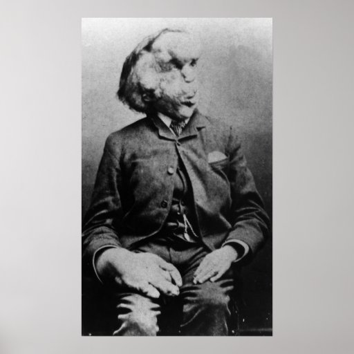 Joseph "John" Merrick The Elephant Man from 1889 Poster | Zazzle