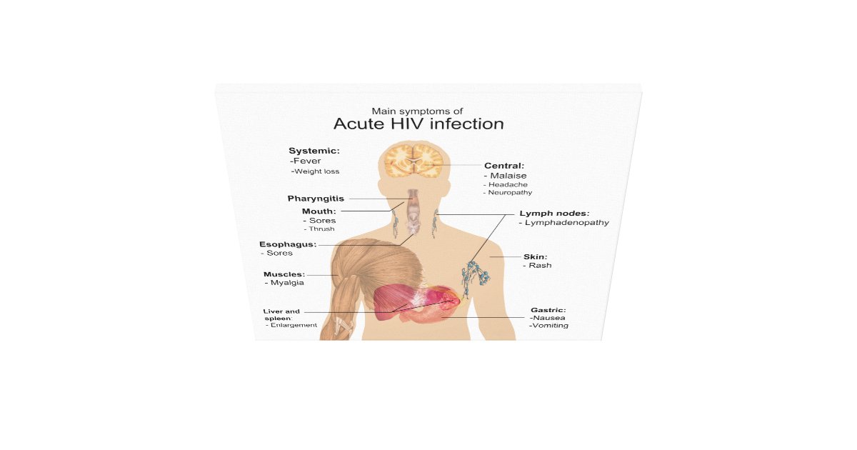 Main Symptoms Of Acute Hiv Infection Canvas Print Zazzle