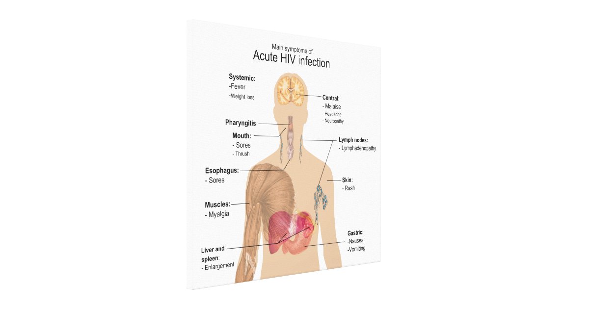 Main Symptoms Of Acute Hiv Infection Canvas Print Zazzle