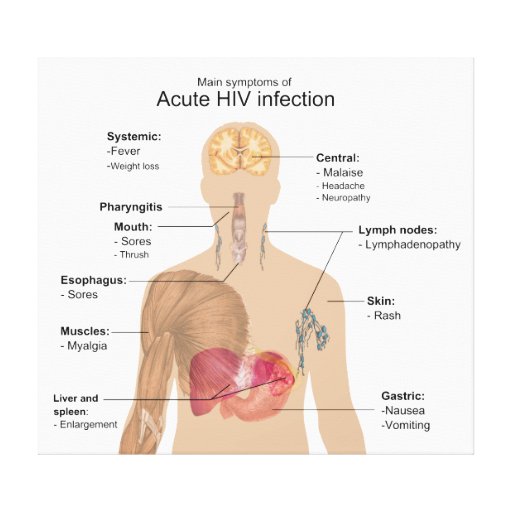 Main Symptoms Of Acute Hiv Infection Canvas Print Zazzle