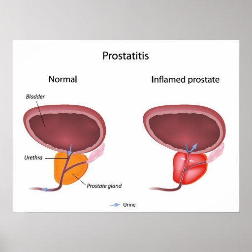 Prostatitis prostate inflammation Poster | Zazzle Prostatitis prostate inflammation Poster | Zazzle