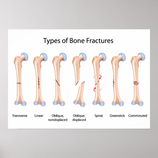 Types Of Bone Fractures Poster Zazzle types-of-bone-fractures-poster-zazzle