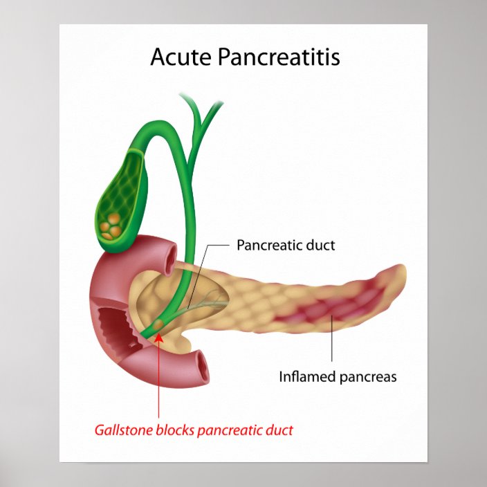 Acute Pancreatitis Poster | Zazzle.com