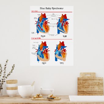Anatomical Heart Diagram of Blue Baby Syndrome Poster | Zazzle