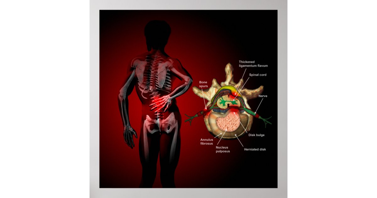 Back pain poster | Zazzle