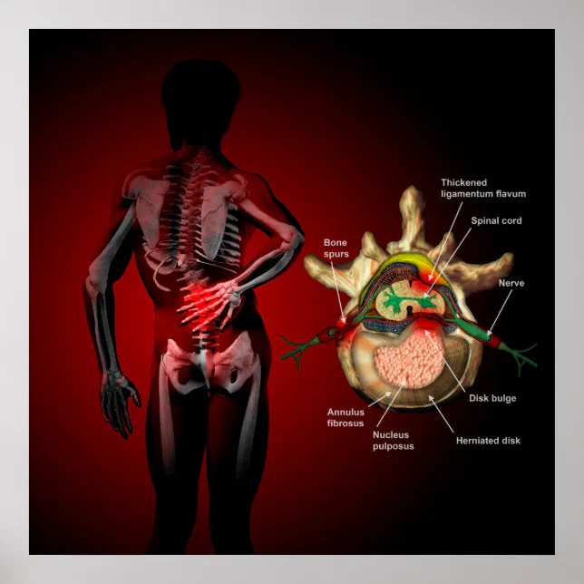 Back pain poster | Zazzle