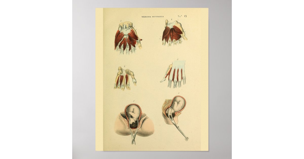 Birth Forceps Obstetrics Anatomy Medical Art Print | Zazzle