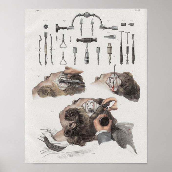 Brain Surgery Instruments Vintage Anatomy Print | Zazzle.com
