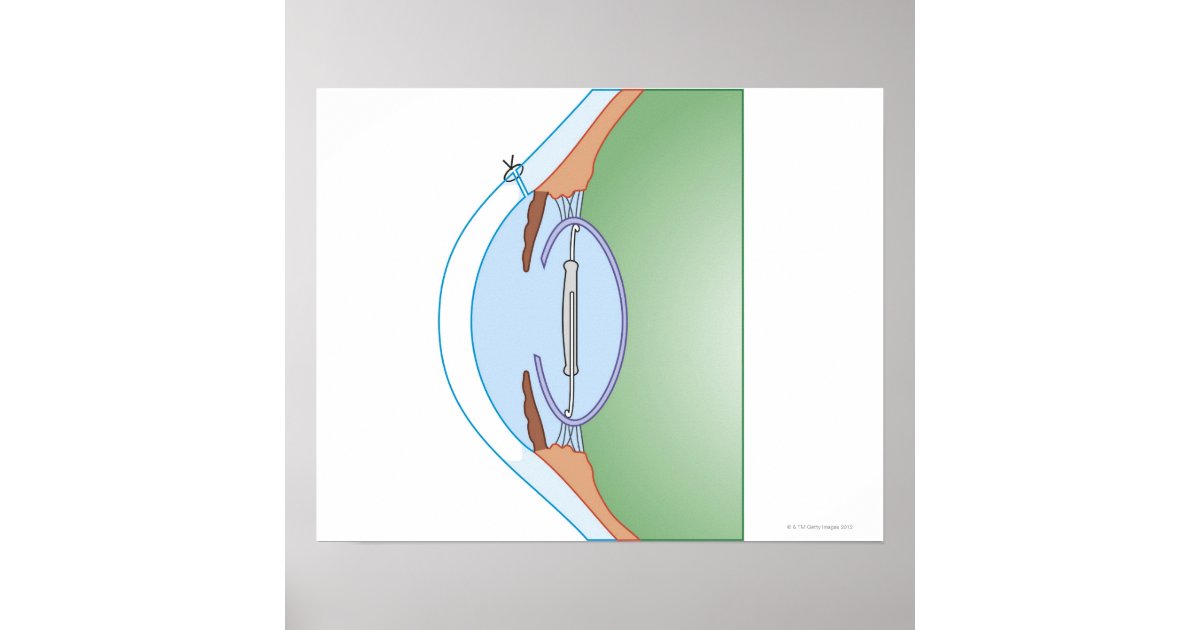 Cataract Surgery Poster | Zazzle