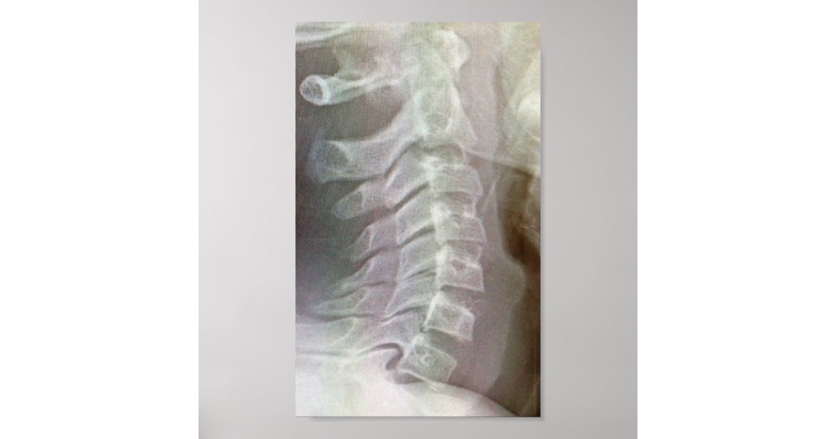 Cervical spine Tie Poster | Zazzle