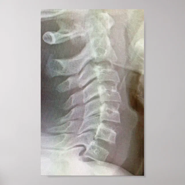 Cervical spine Tie Poster | Zazzle