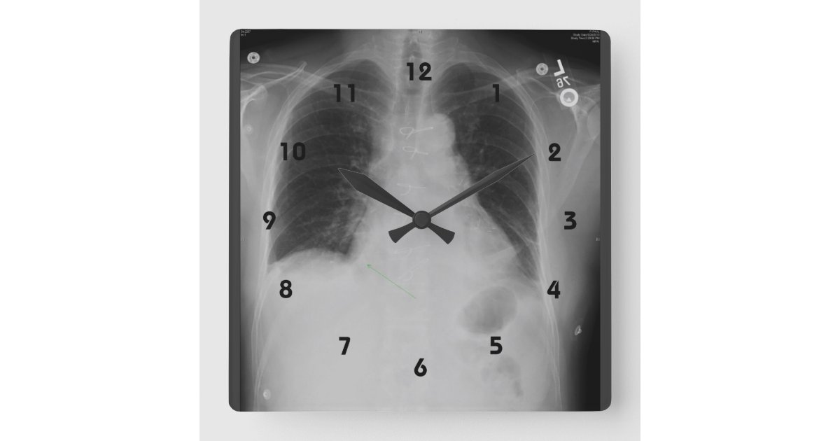Chest X Ray ~ Clock | Zazzle