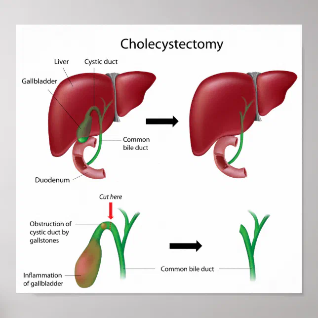 Cholecystectomy gallbladder removal surgery Poster | Zazzle