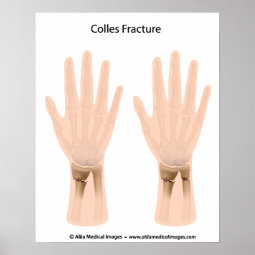 Colles fracture, medical illustration. poster | Zazzle