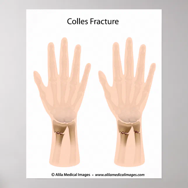 Colles fracture, medical illustration. poster | Zazzle