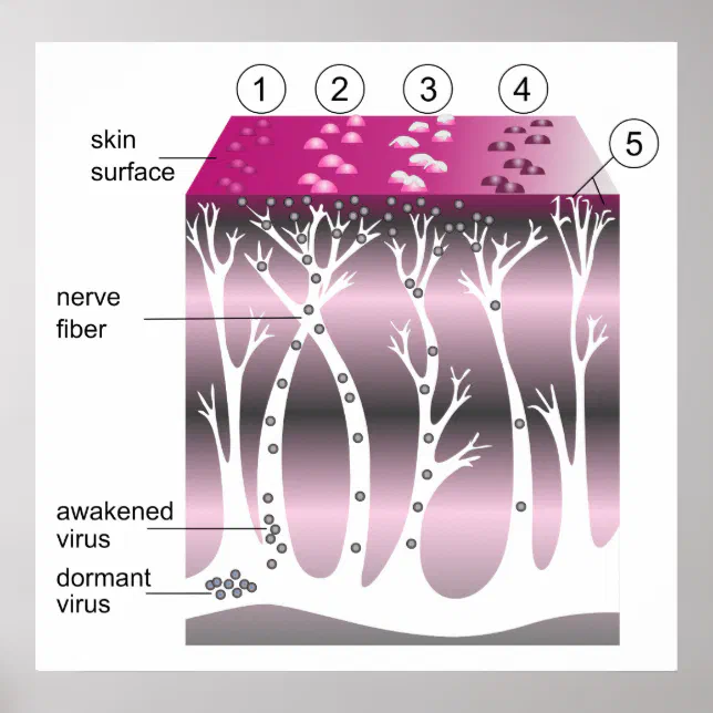 Diagram of the Progression of Shingles on Skin Poster | Zazzle