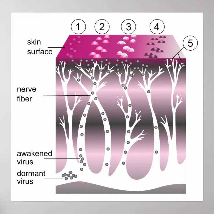 Diagram of the Progression of Shingles on Skin Poster | Zazzle