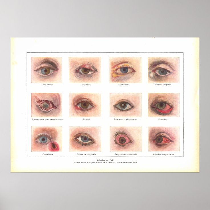 Diseases of Eye Anatomy Poster French | Zazzle