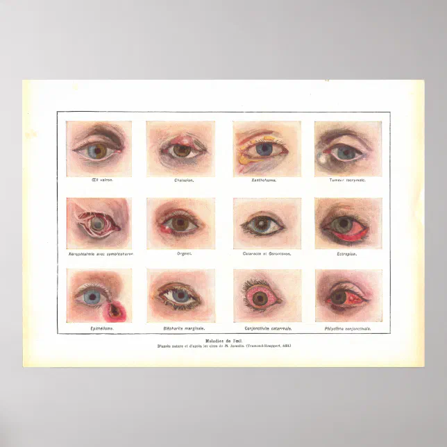 Diseases of Eye Anatomy Poster French | Zazzle