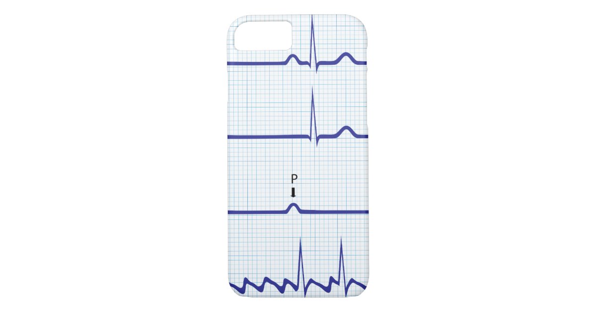 ECG/EKG iPhone case | Zazzle