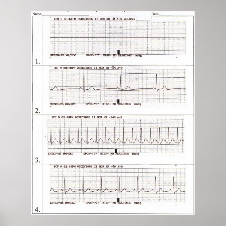 ekg Rhythms Poster | Zazzle