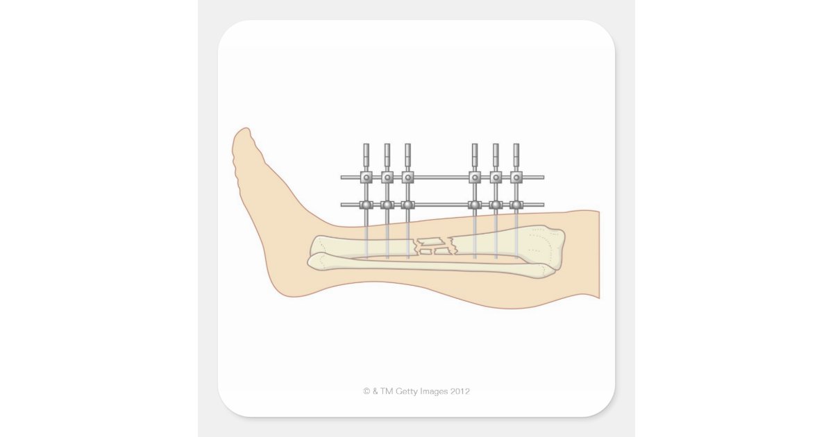 External Fixator Square Sticker | Zazzle