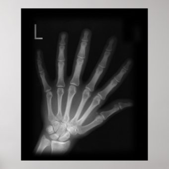 Extra Digit X-ray Left Hand Poster | Zazzle