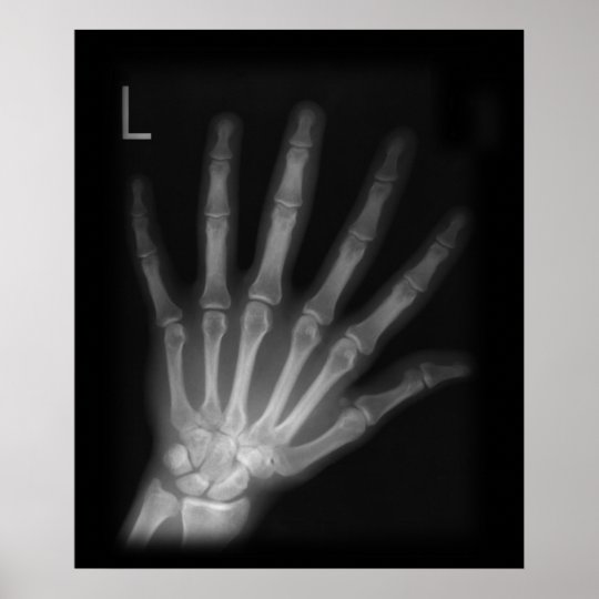 Extra Digit X-ray Left Hand Poster | Zazzle.com