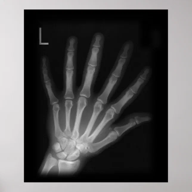 Extra Digit X-ray Left Hand Poster | Zazzle