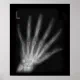 Extra Digit X-ray Left Hand Poster | Zazzle