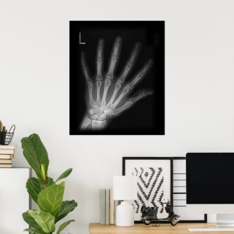 Extra Digit X-ray Left Hand Poster | Zazzle