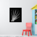 Extra Digit X-ray Left Hand Poster | Zazzle