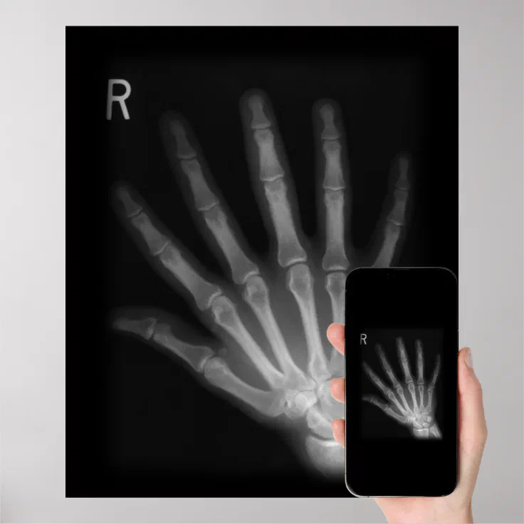 Extra Digit X-ray Right Hand Poster | Zazzle