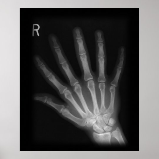Extra Digit X-ray Right Hand Poster | Zazzle.com