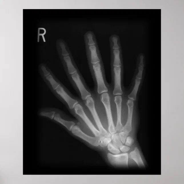 Extra Digit X-ray Right Hand Poster | Zazzle