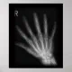 Extra Digit X-ray Right Hand Poster | Zazzle