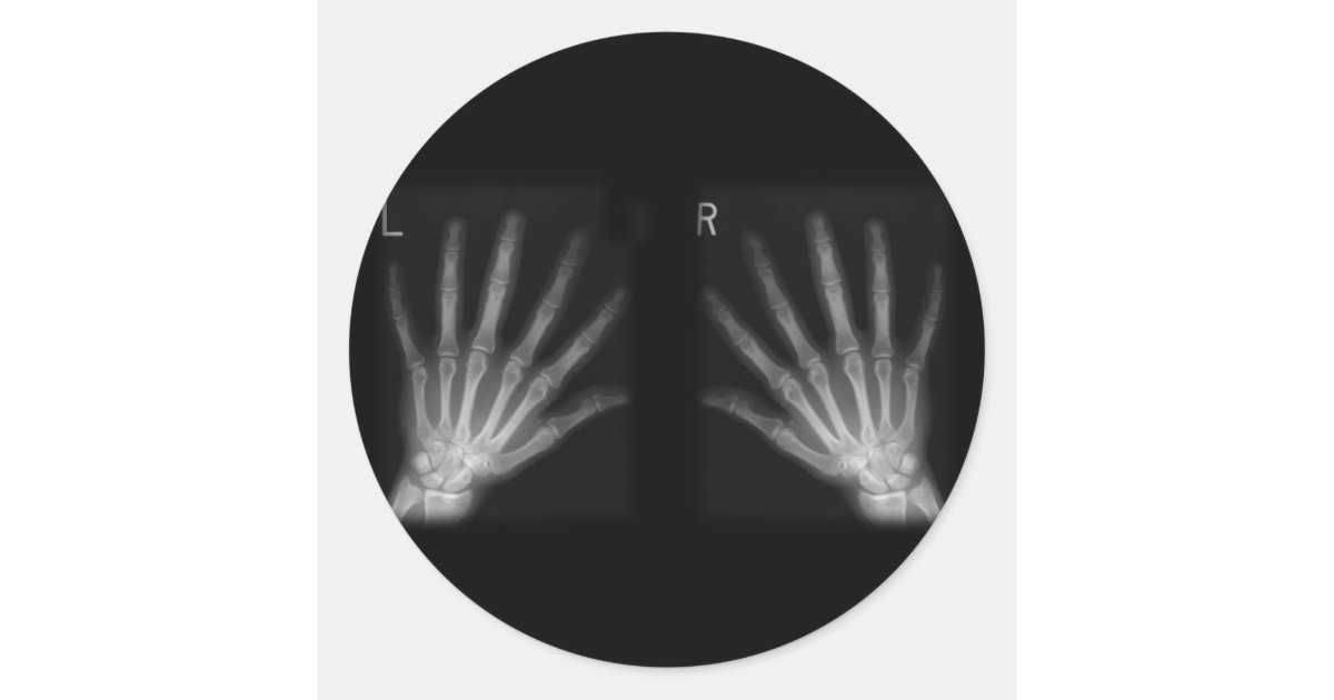 Extra Digit X-ray Right & Left Hands Classic Round Sticker | Zazzle