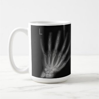 Extra Digit X-ray Right & Left Hands Coffee Mug | Zazzle