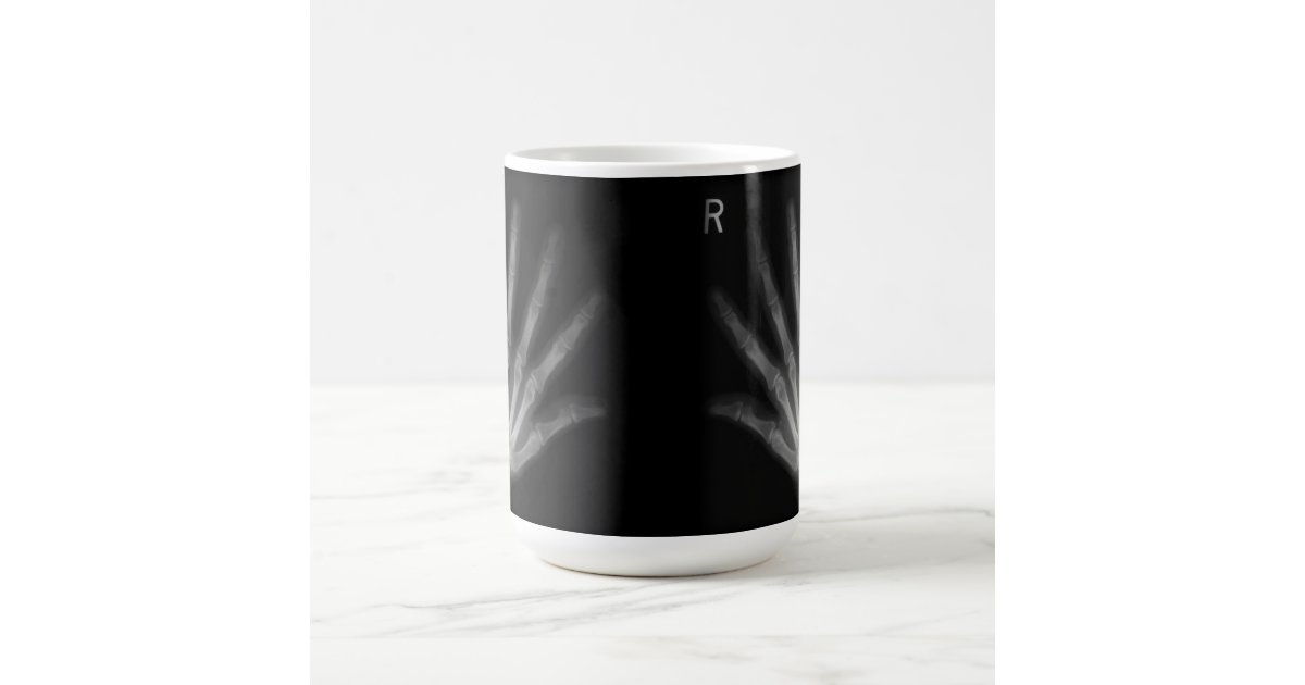 Extra Digit X-ray Right & Left Hands Coffee Mug | Zazzle