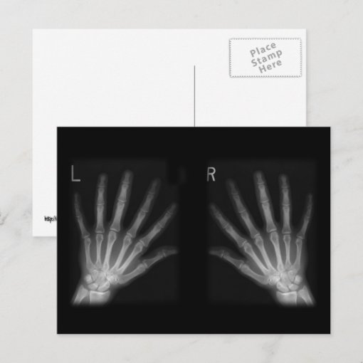 Extra Digit X-ray Right & Left Hands Postcard | Zazzle
