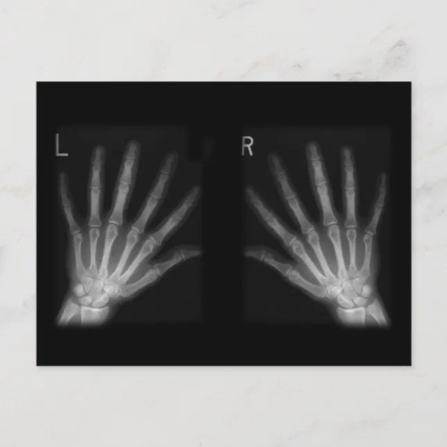 Extra Digit X-ray Right & Left Hands Postcard | Zazzle