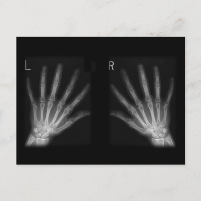 Extra Digit X-ray Right & Left Hands Postcard | Zazzle.com