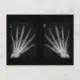 Extra Digit X-ray Right & Left Hands Postcard | Zazzle