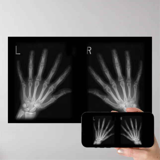 Extra Digit X-ray Right & Left Hands Poster | Zazzle