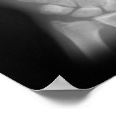 Extra Digit X-ray Right & Left Hands Poster | Zazzle