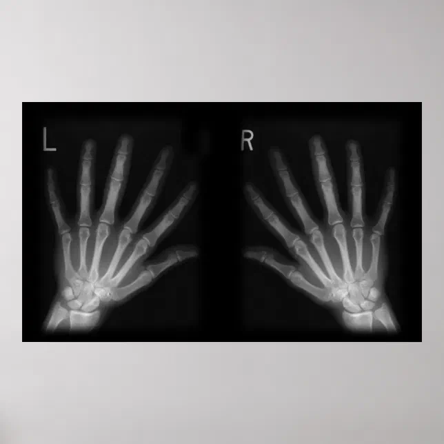 Extra Digit X-ray Right & Left Hands Poster | Zazzle