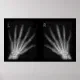 Extra Digit X-ray Right & Left Hands Poster | Zazzle