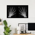 Extra Digit X-ray Right & Left Hands Poster | Zazzle