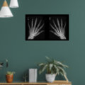 Extra Digit X-ray Right & Left Hands Poster | Zazzle